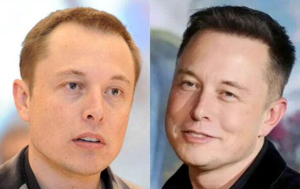 Elon Musk Hair Transplant | Before & After Journey
