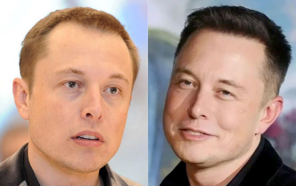 Elon Musk Hair Transplant | Before & After Journey
