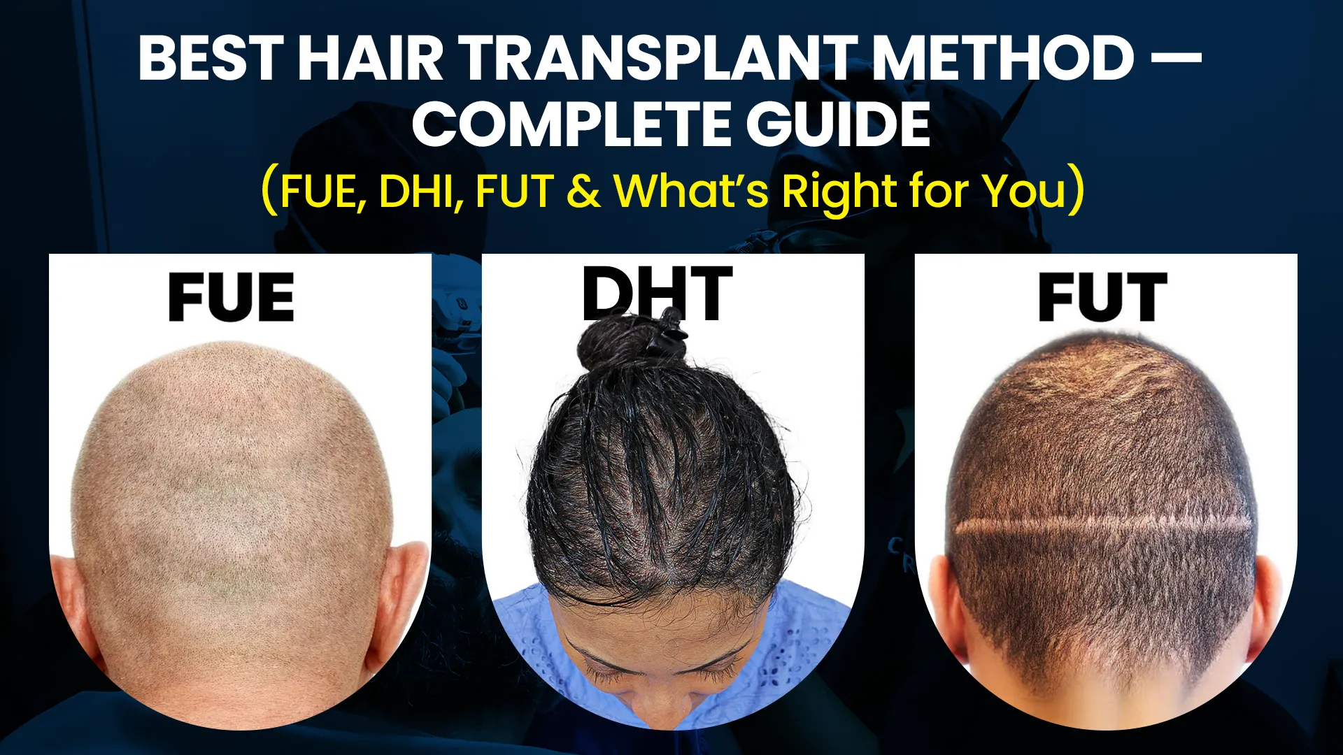 Best Hair Transplant Method | Safe & Effective Hair Restoration